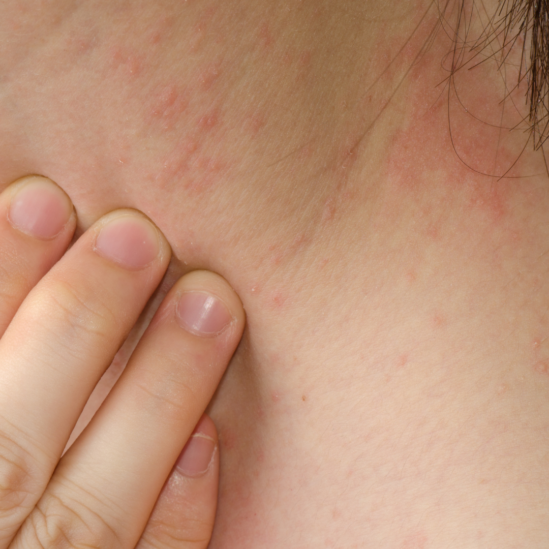 Skin Cancer Screening in Bend, OR - Juniper Dermatology