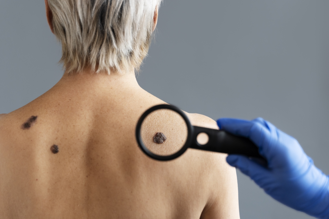 Mole Removal in Bend, OR - Juniper Dermatology