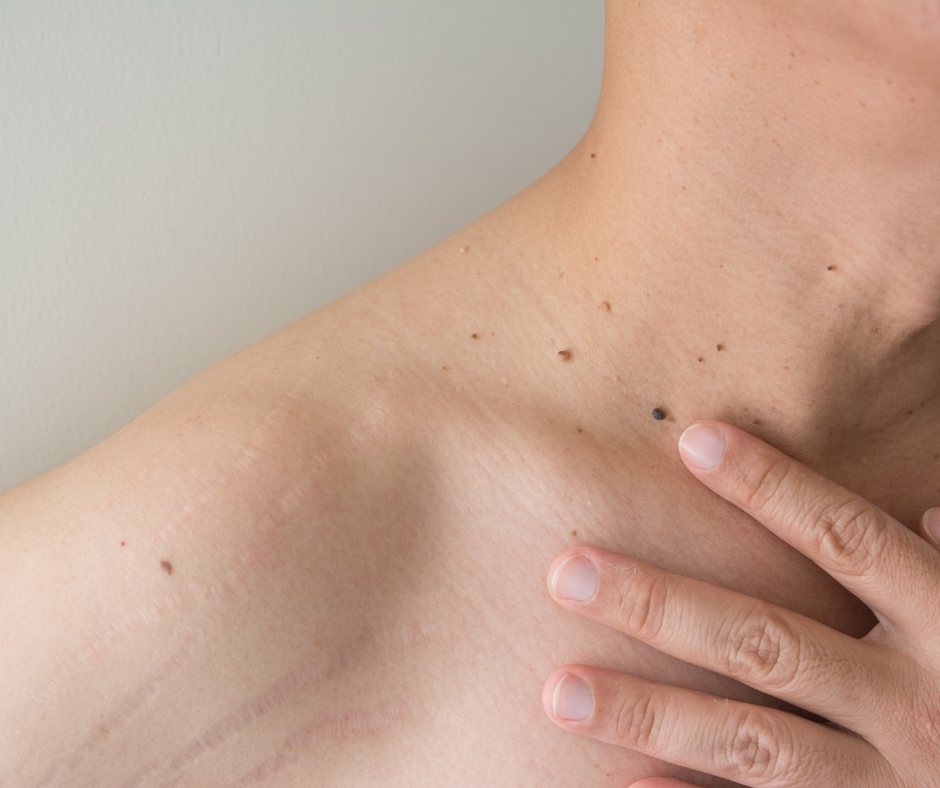Mole Removal - Juniper Dermatology